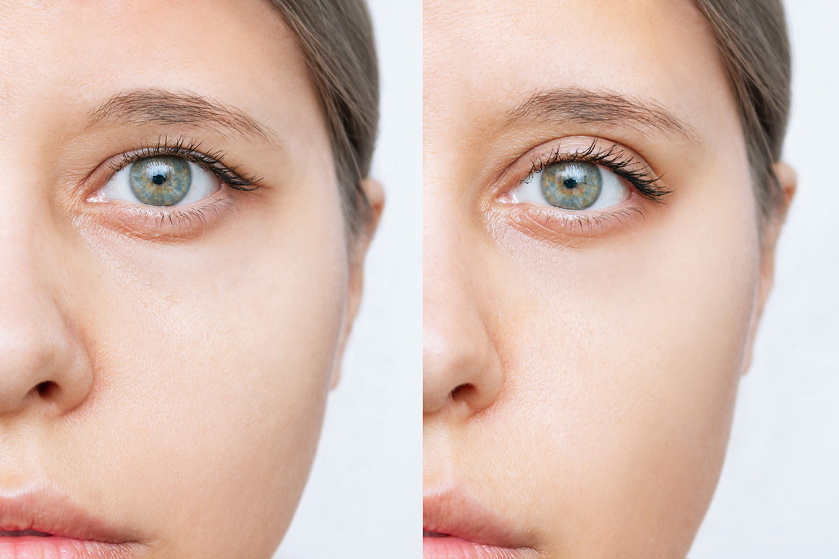 Enhanced Vision – Glow Blepharoplasty Light